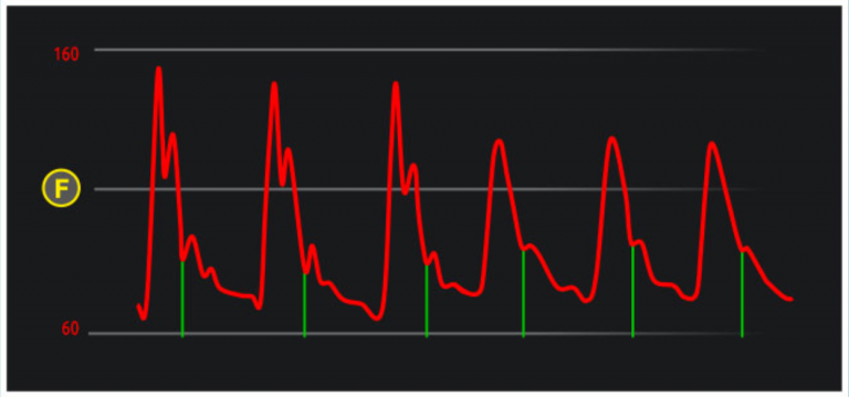 MOSTCARE UP - STIMA STATO INFIAMMATORIO DA ONDA DI PRESSIONE - Vygon Italia